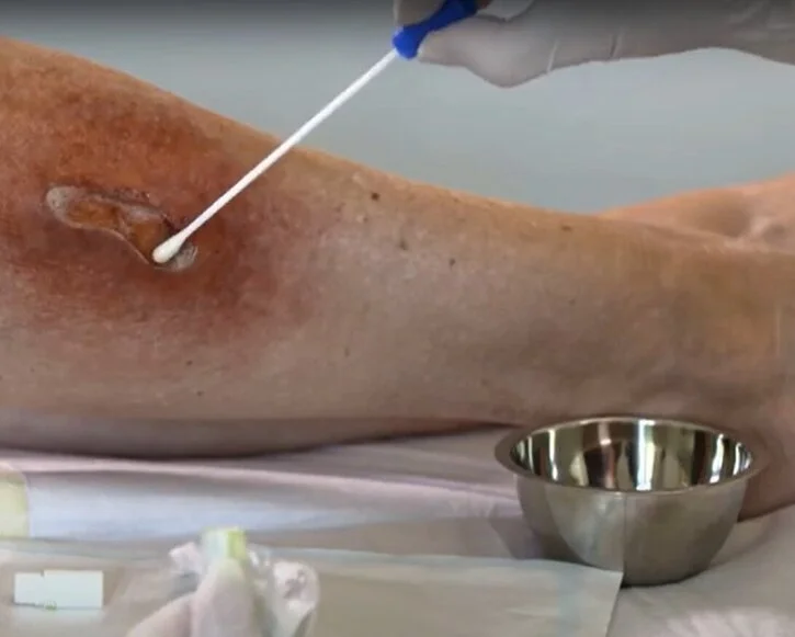 ‘Klug entscheiden’ bei chronischen Wunden