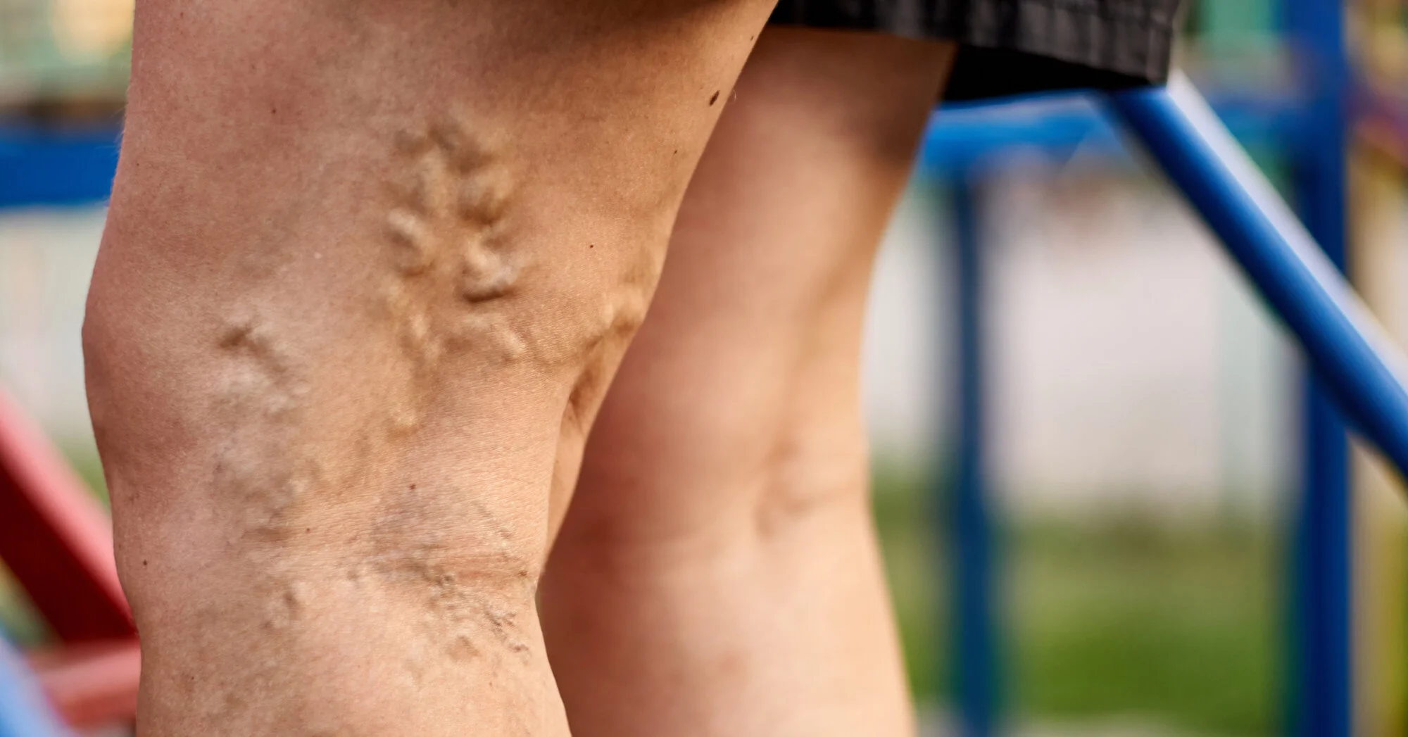 CEAP-Klassifikation der CVI und chronischen Venenerkrankungen