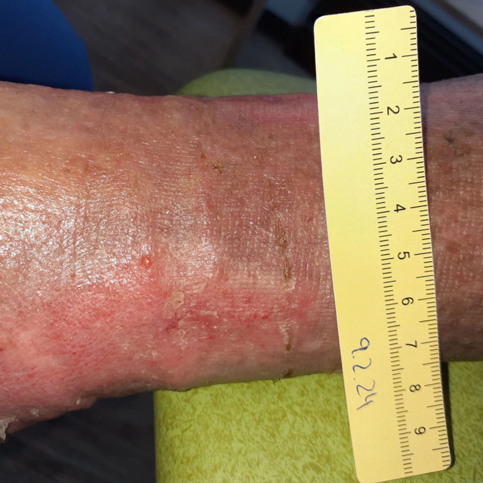 Fallbeispiel: Ulcus cruris venosum an beiden Unterschenkeln