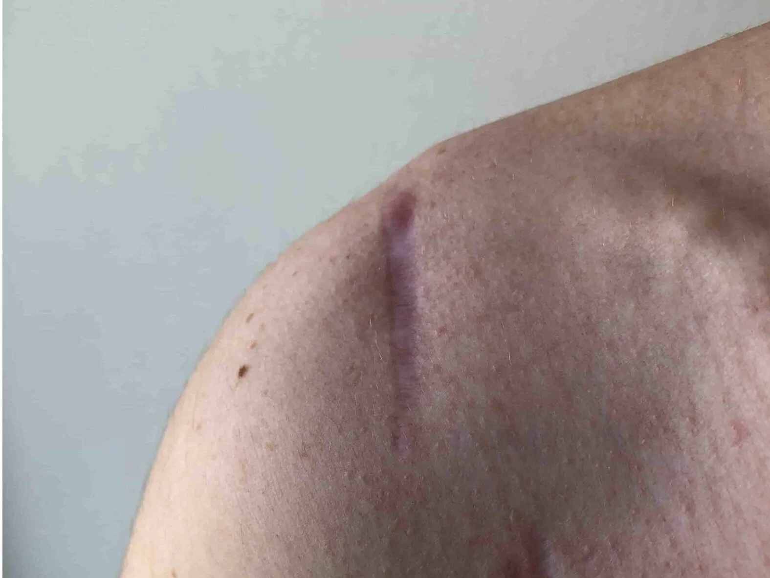 Operationswunden: Behandlung, Wundversorgung von OP-Wunden