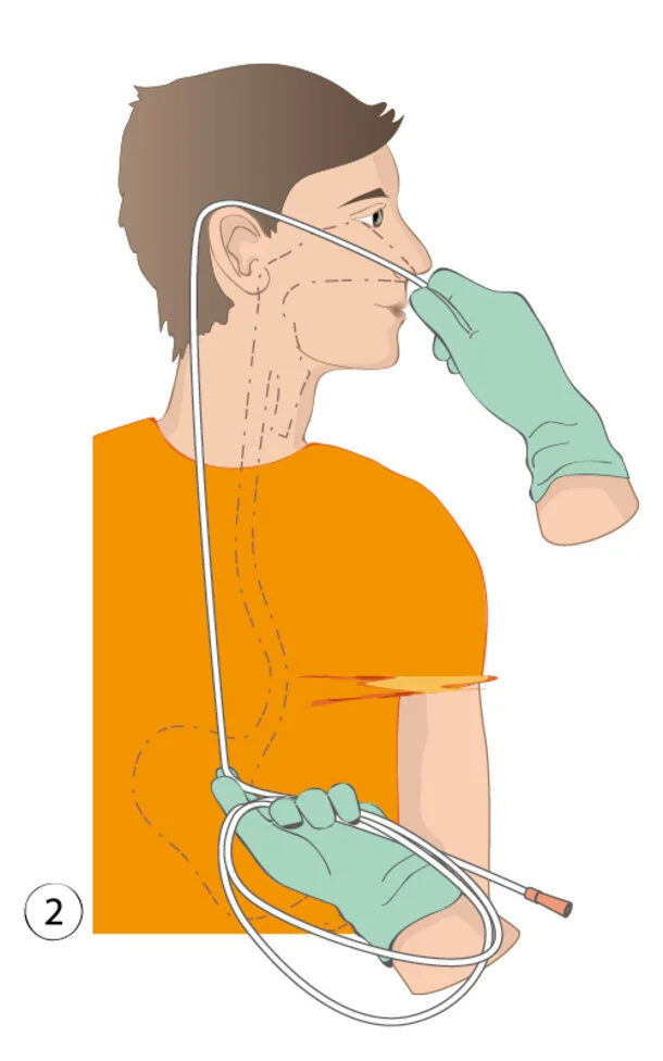 Enterale Ernährung: Sonden richtig legen und pflegen