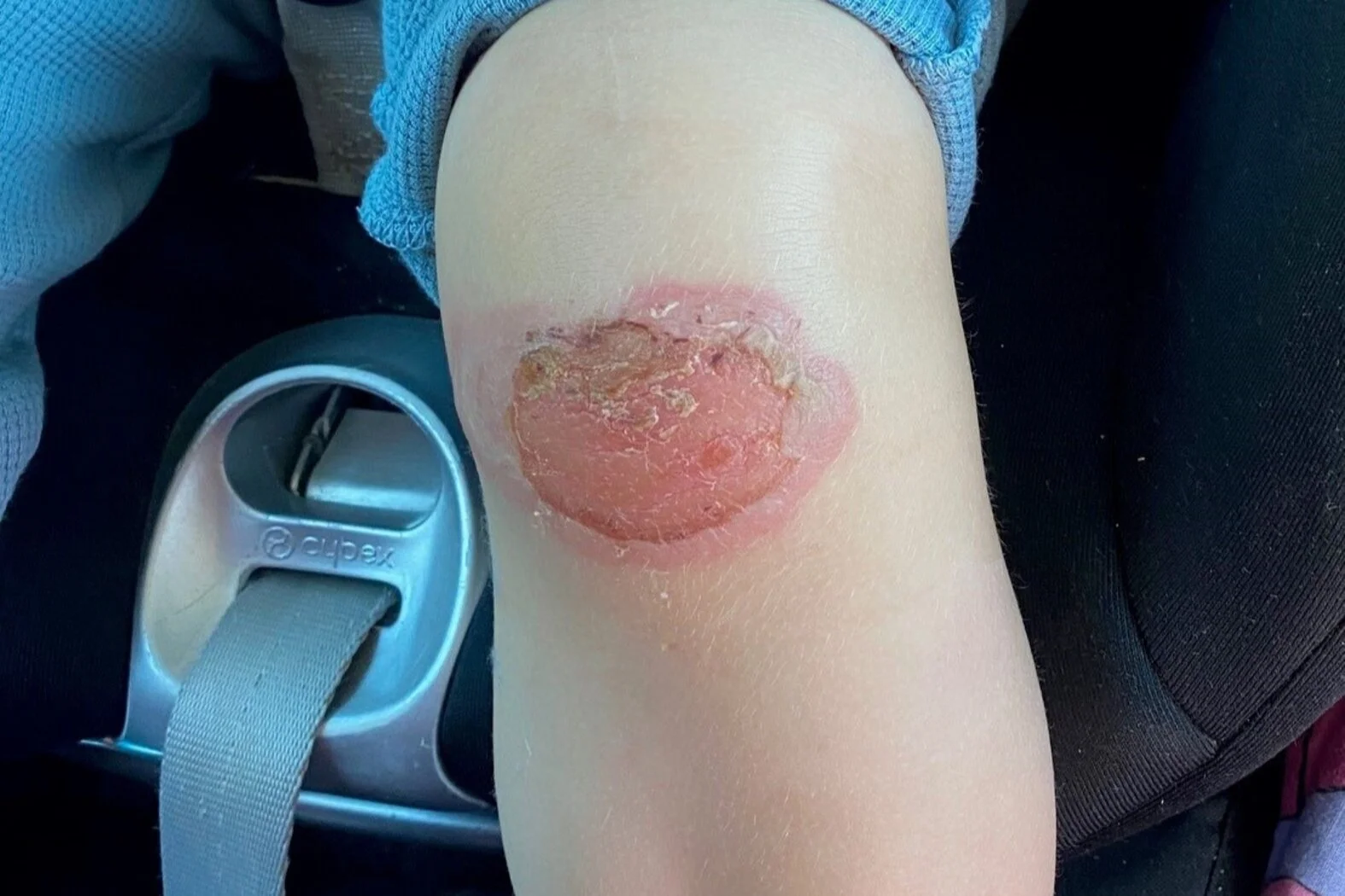 Fallbeispiel: Schürfwunde am Knie, Heilungsverlauf, Fotos