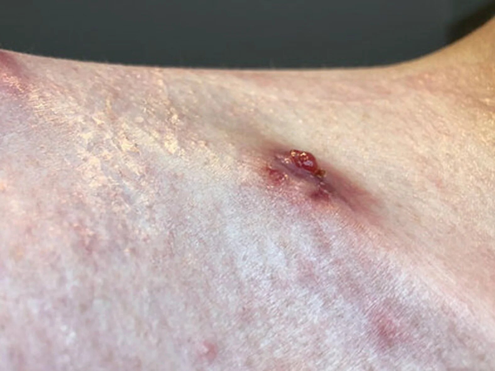 Hypergranulation: überschießendes Granulationsgewebe bei Wunden