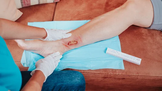 Ulcus Cruris: Ursachen für ein 'offenes Bein', Therapie