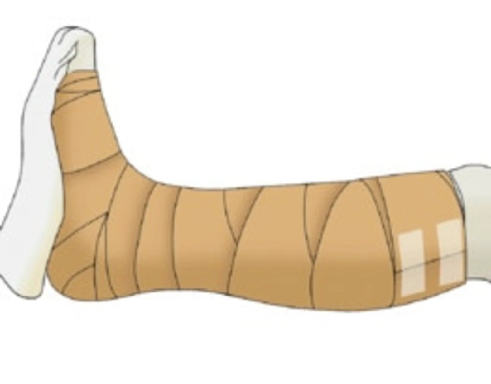 Ulcus cruris venosum - Wundversorgung