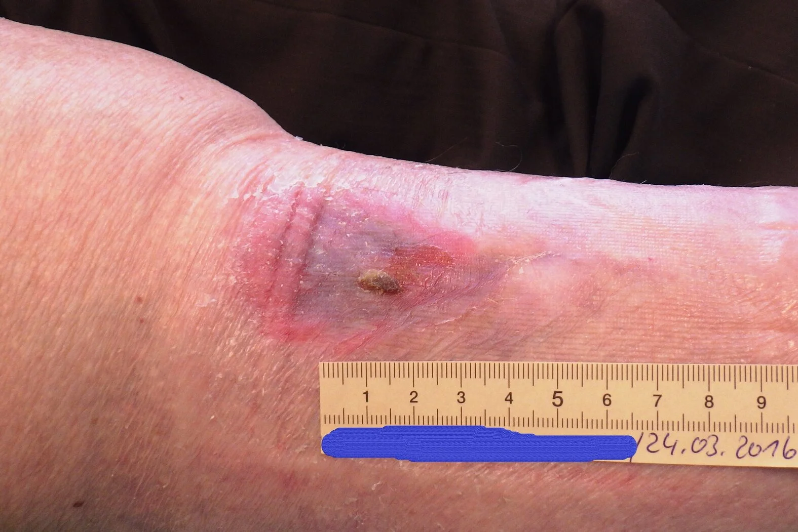 Fallbeispiel: Ulcus cruris venosum mit moderat ausgeprägter pAVK