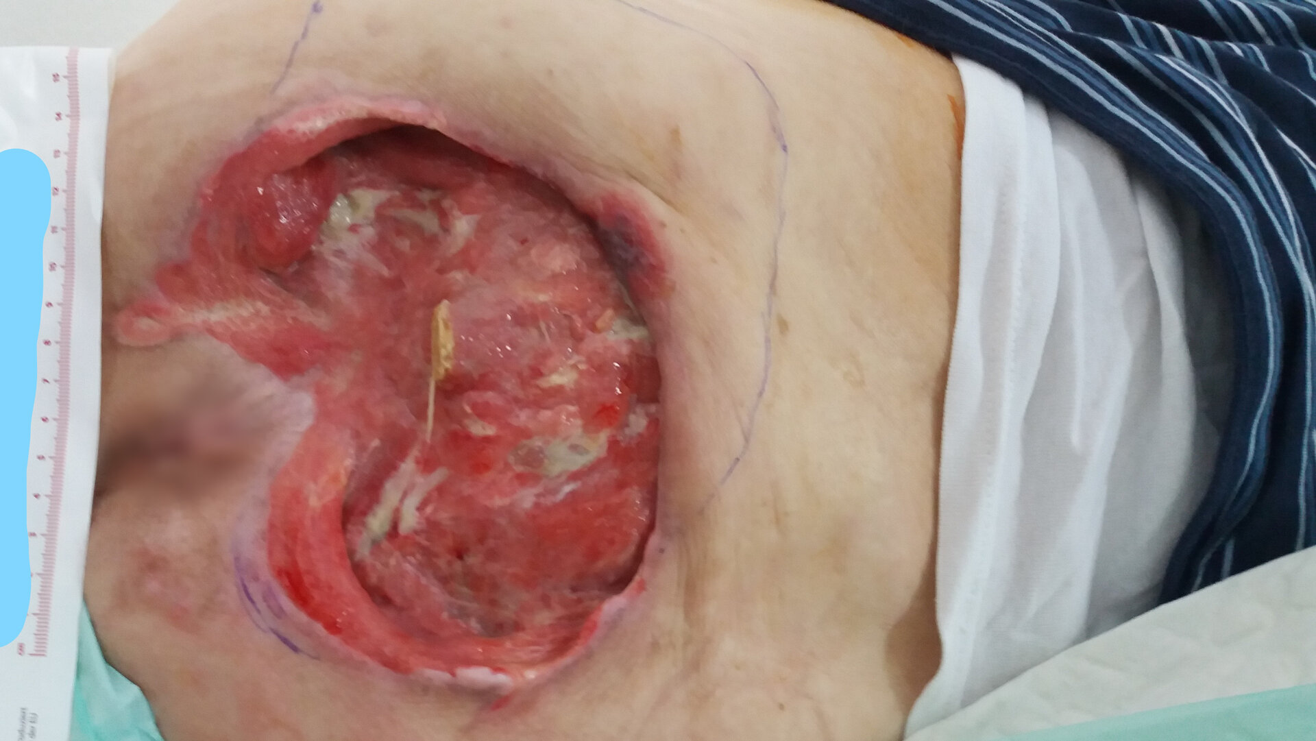 Fallbeispiel: Dekubitus Grad 4 nach Darm-Operation