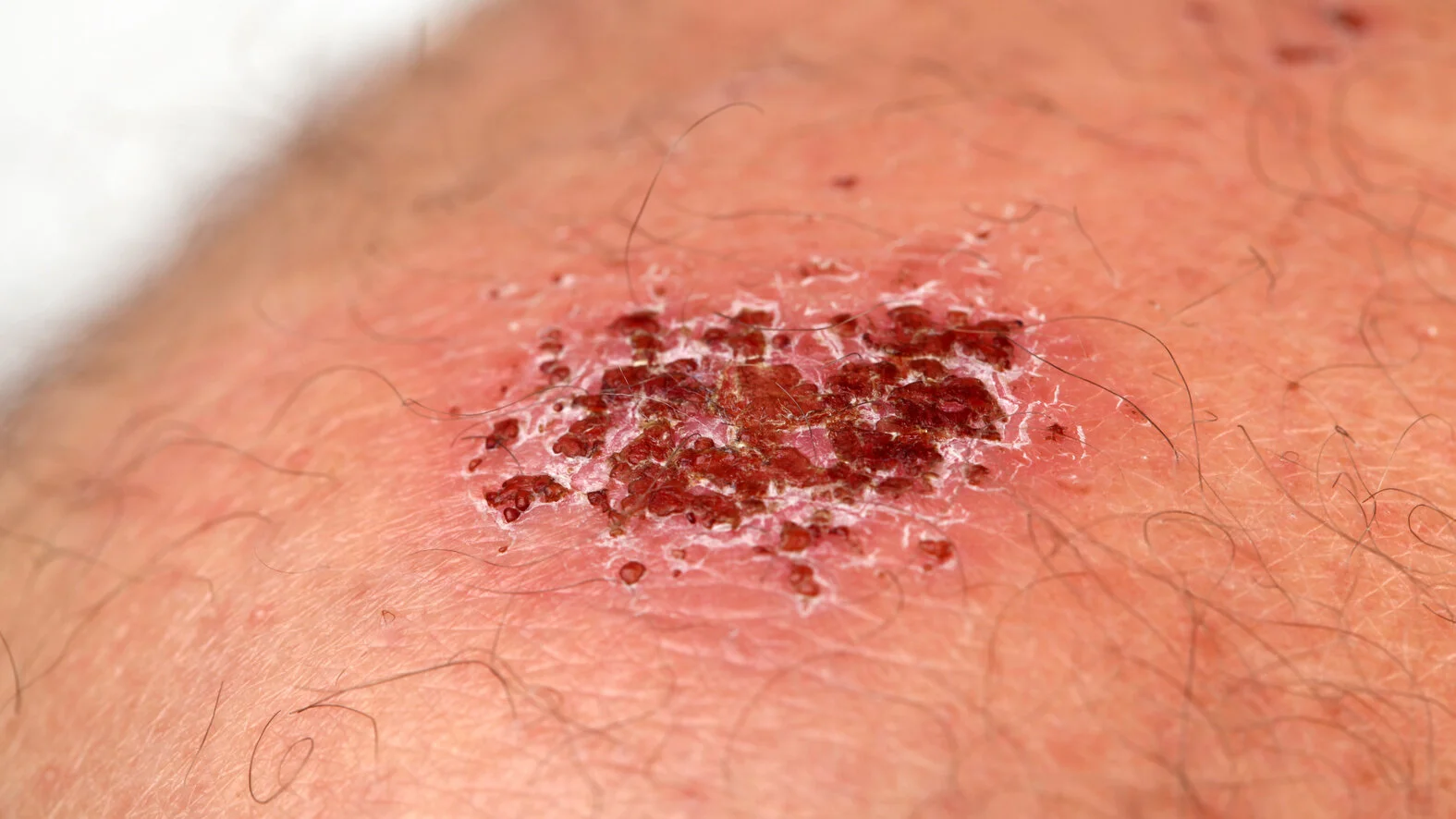 Wundkruste: Wundschorf, Versorgung bei Schorf auf der Wunde