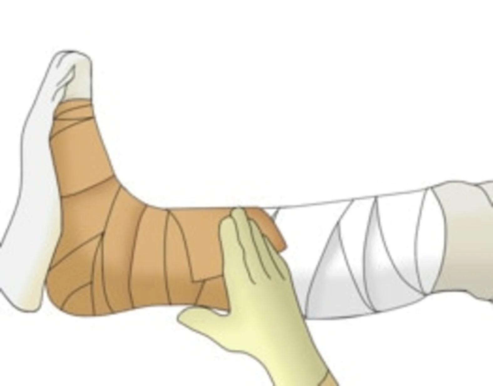 Ulcus cruris venosum - Wundversorgung