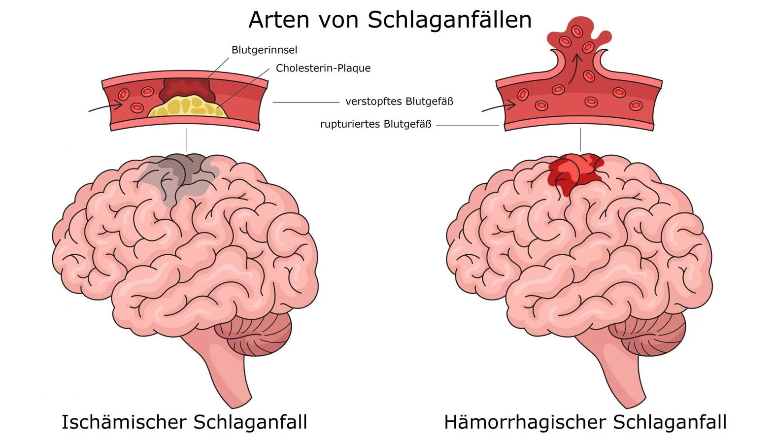 Apoplex: Schlaganfall rechtzeitig erkennen, Komplikationen vermeiden