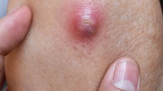 Abszess: Behandlung, Versorgung von Abszessen und Abszesswunden