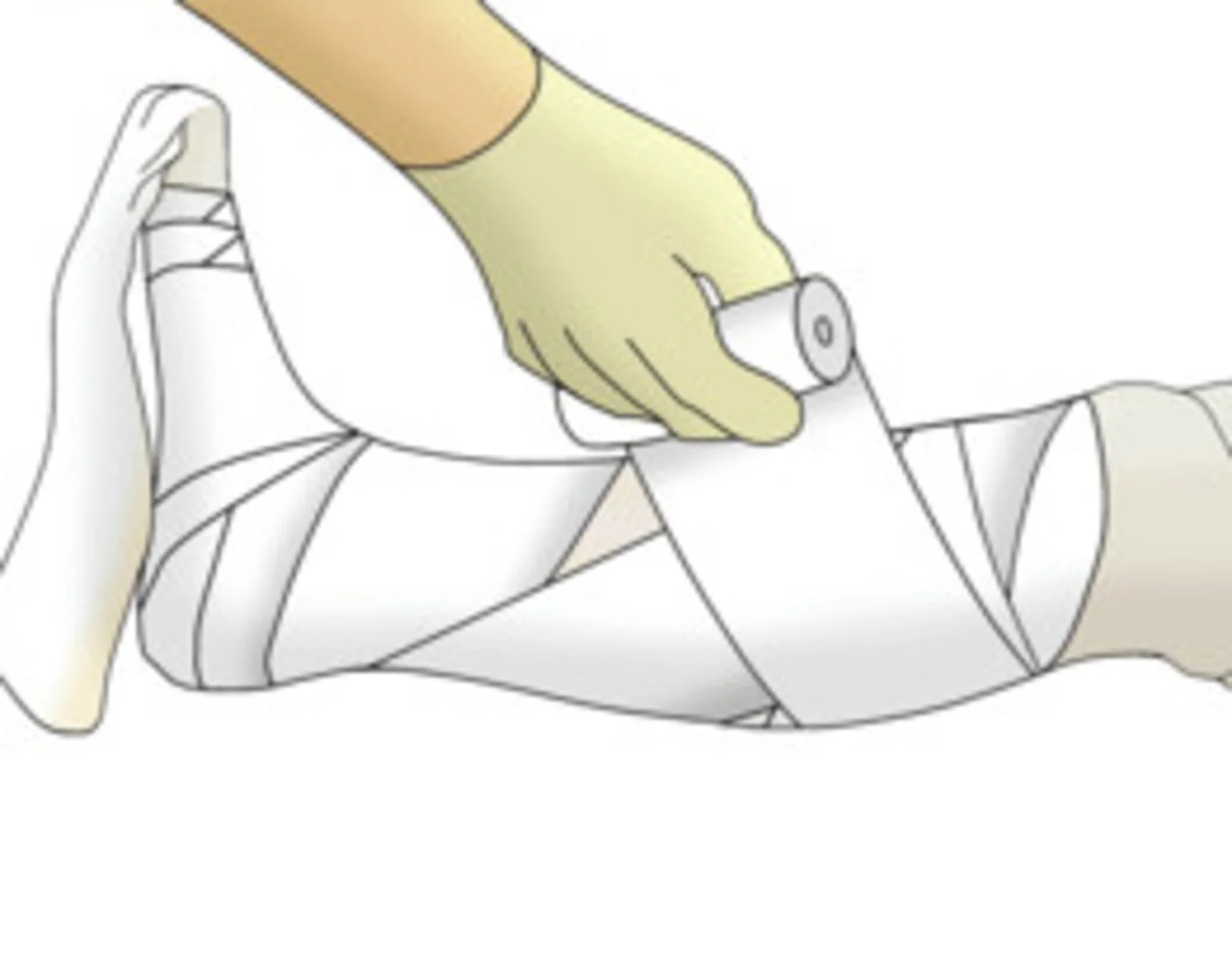 Ulcus cruris venosum - Wundversorgung