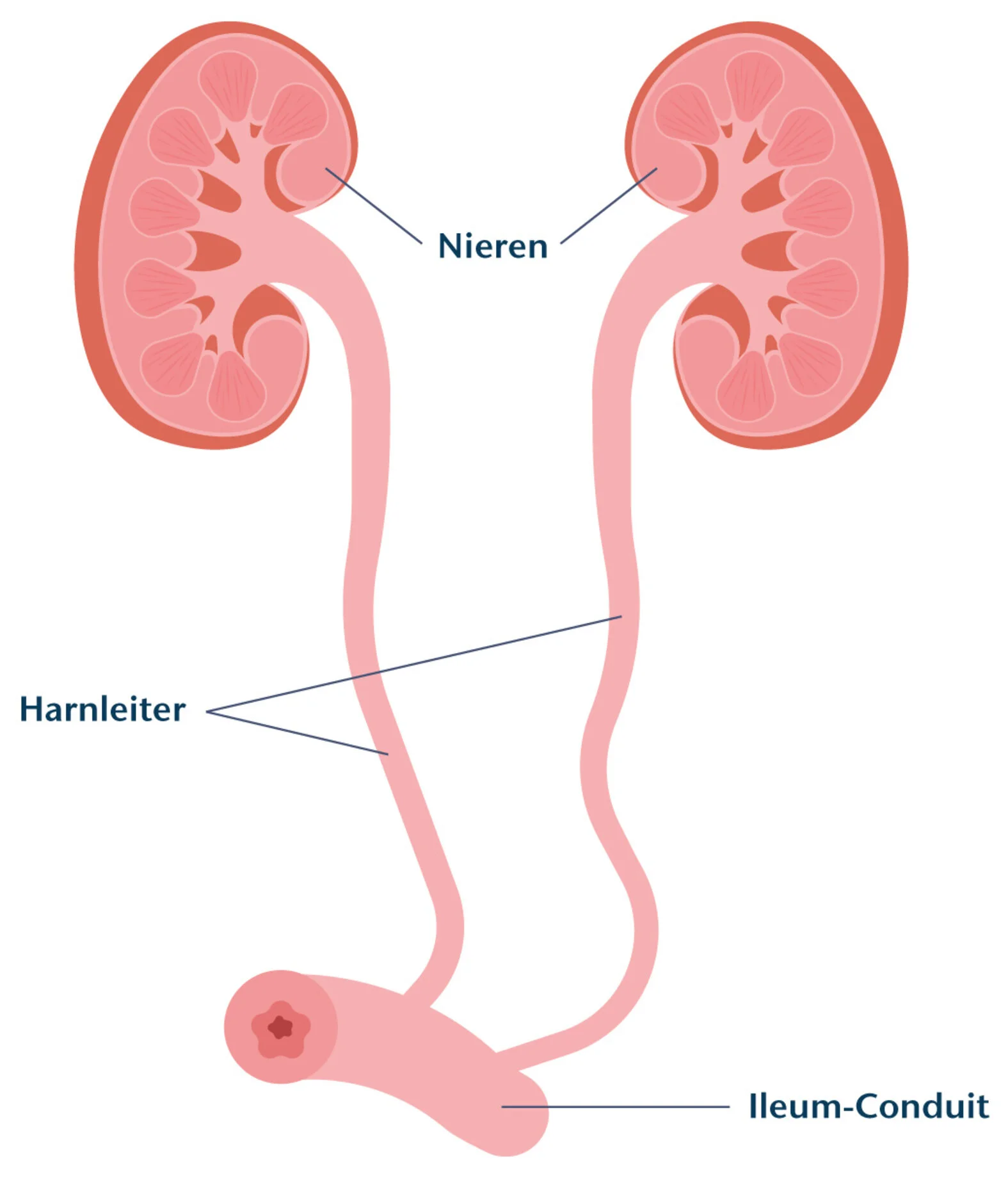 Urostoma: 7 Dinge, die Pflegekräfte wissen sollten