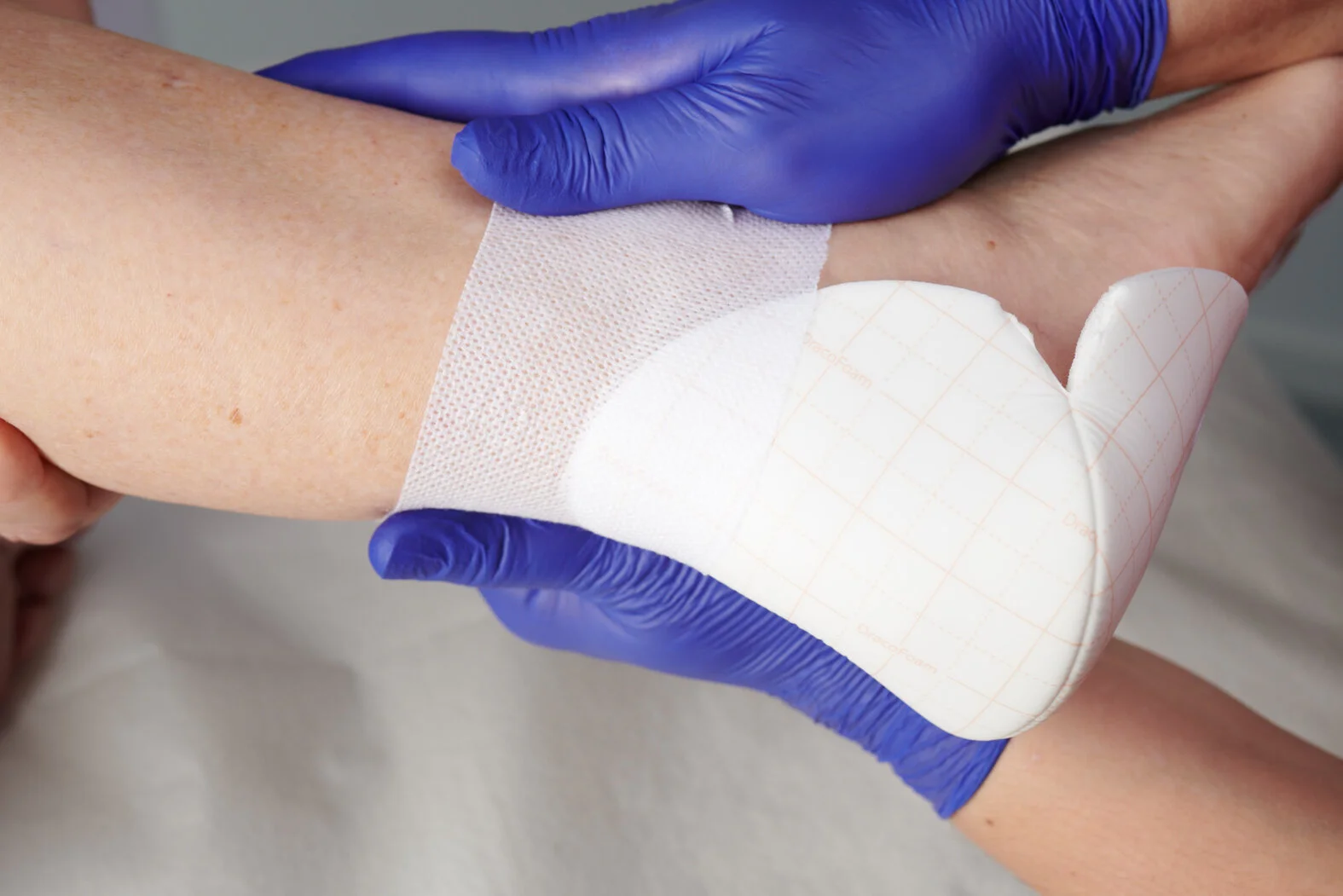 Fersendekubitus - Druckgeschwür an der Ferse. Prophylaxe, Therapie