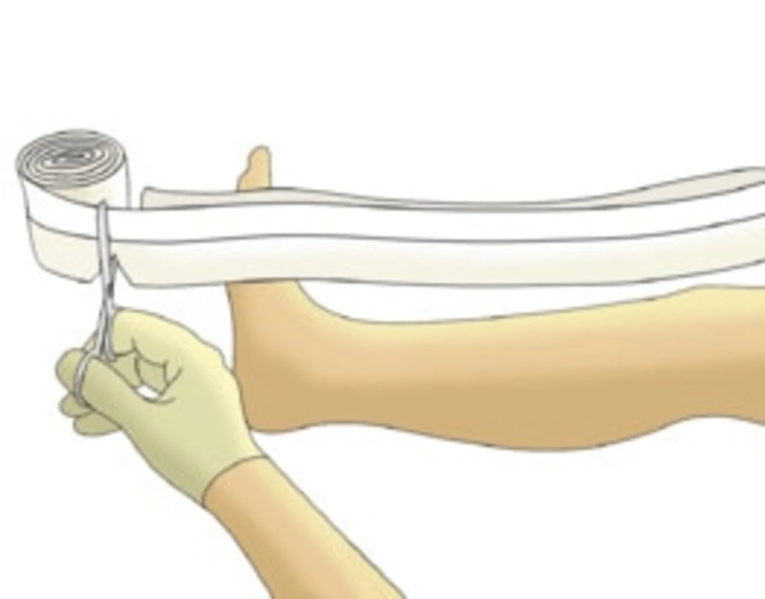 Ulcus cruris venosum - Wundversorgung