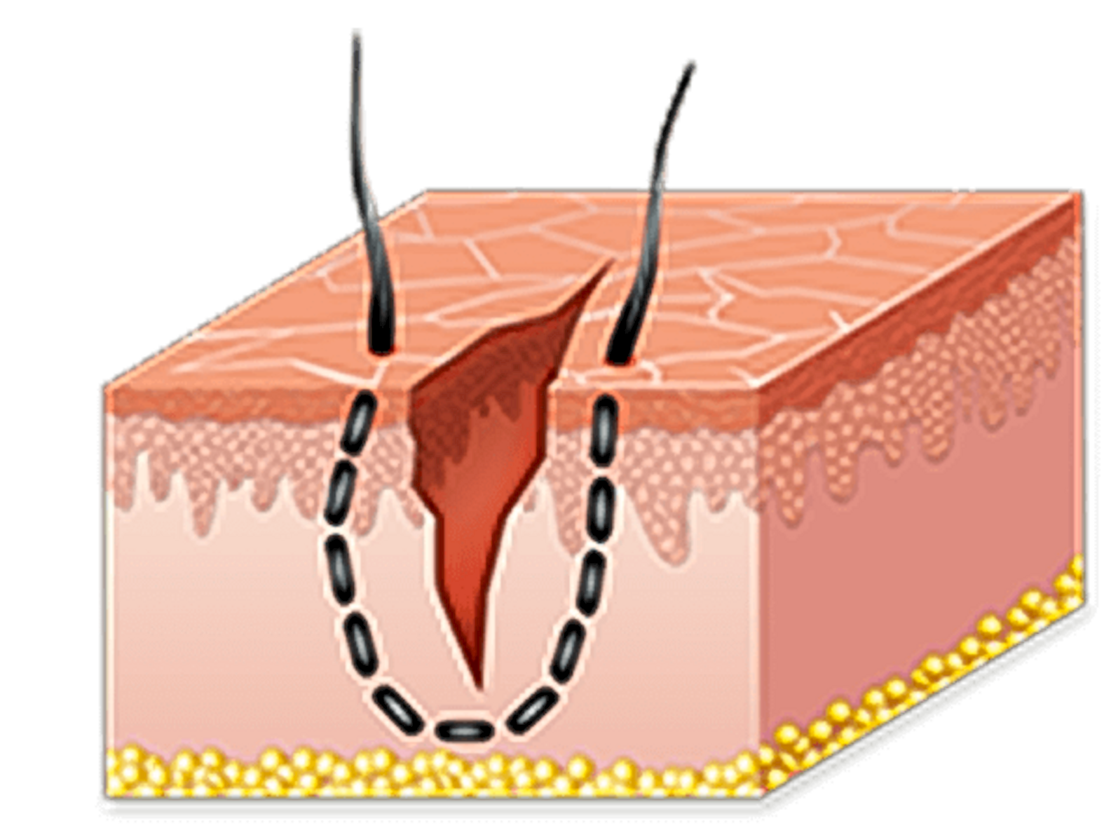 Wundnähte: Wundnaht nähen und versorgen, Techniken