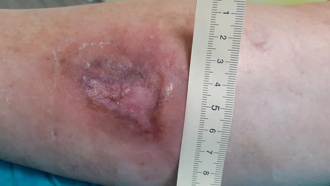 Fallbeispiel: Pyoderma gangraenosum, Therapie, Heilung