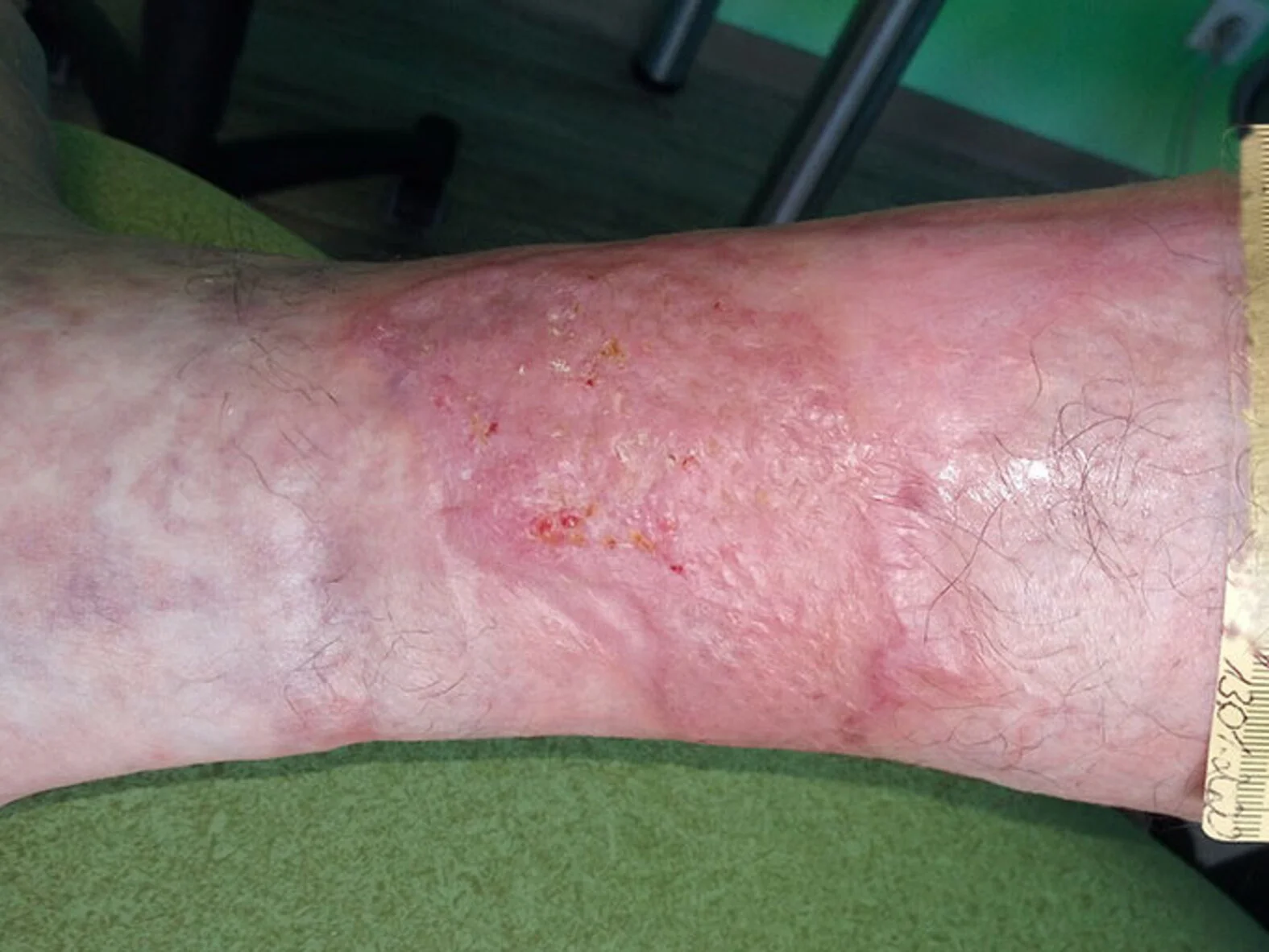 Fallbeispiel: Pyoderma gangraenosum, Wundversorgung