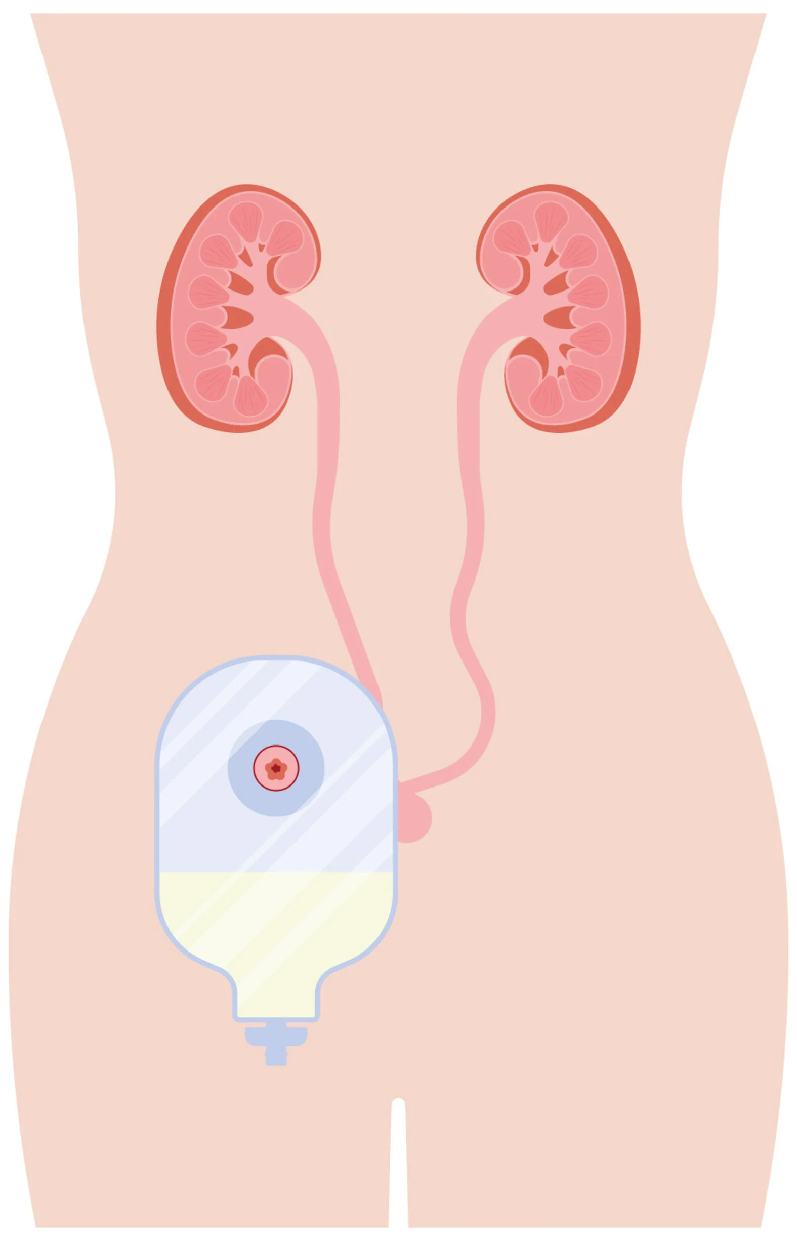 Pflege Von Menschen Mit Enterostoma Und Urostoma – GIAU