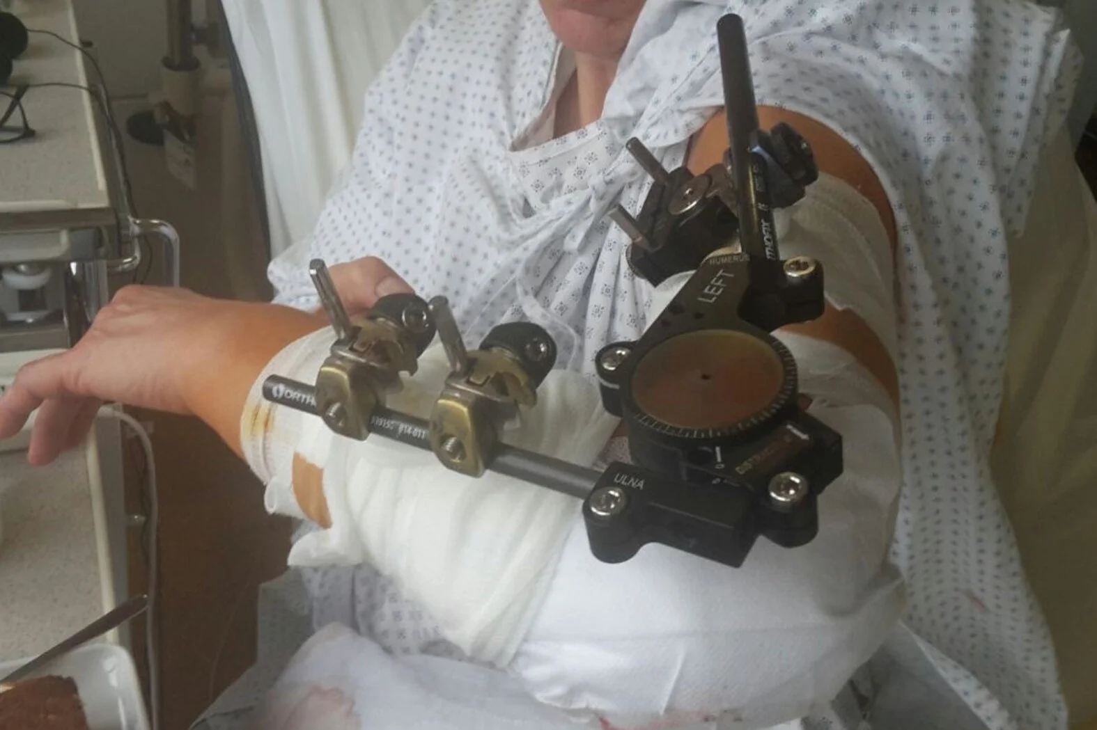 Fixateur externe: Empfehlungen zu Pflege und Infektionsprophylaxe