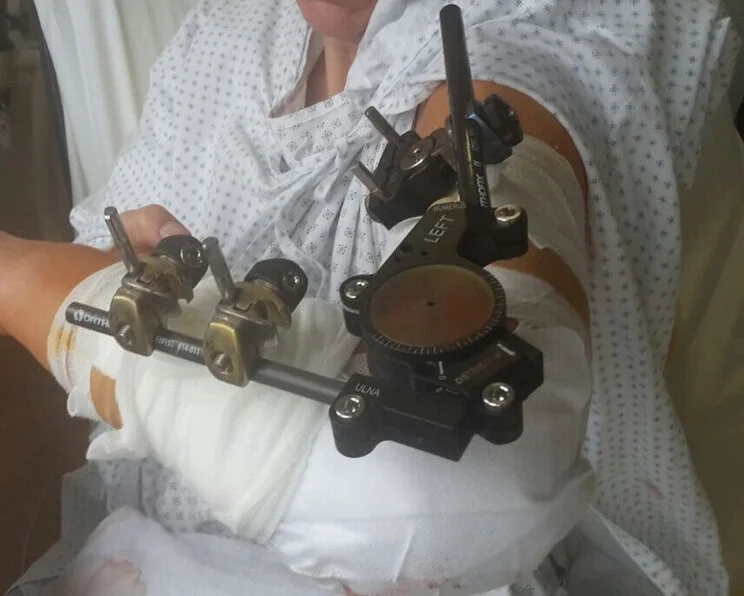 Fixateur externe: Empfehlungen zu Pflege und Infektionsprophylaxe