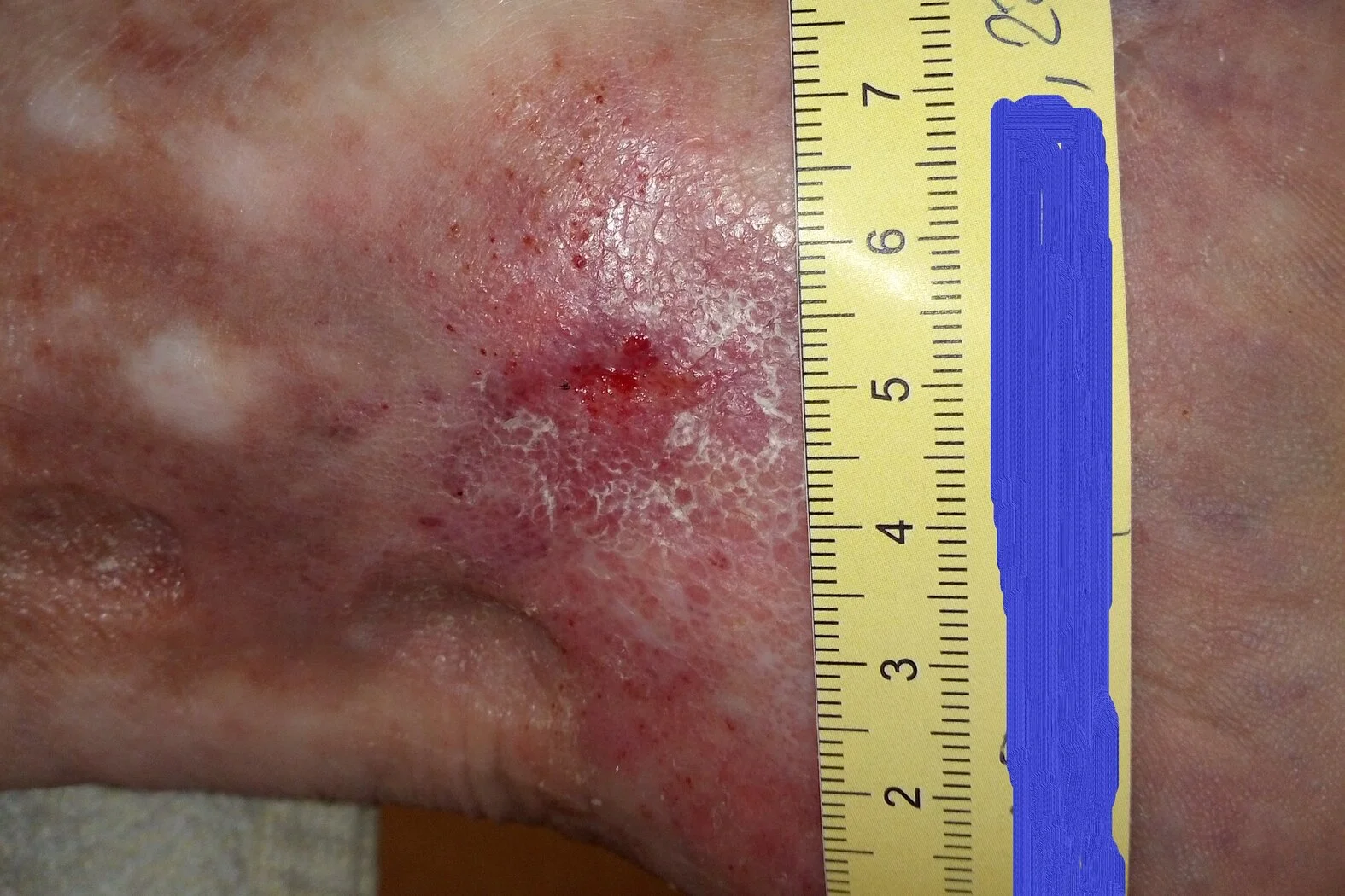 Fallbeispiel: Ulcus cruris venosum bei Perforansinsuffizienz (mit Bildern)