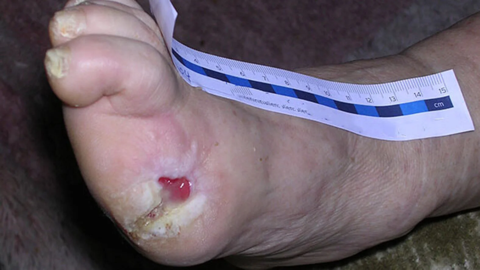 Mazeration: Behandlung mazerierender Wunden, Prophylaxe