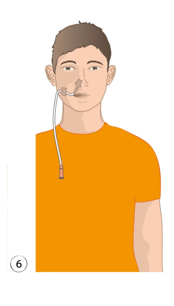 Enterale Ernährung: Sonden richtig legen und pflegen