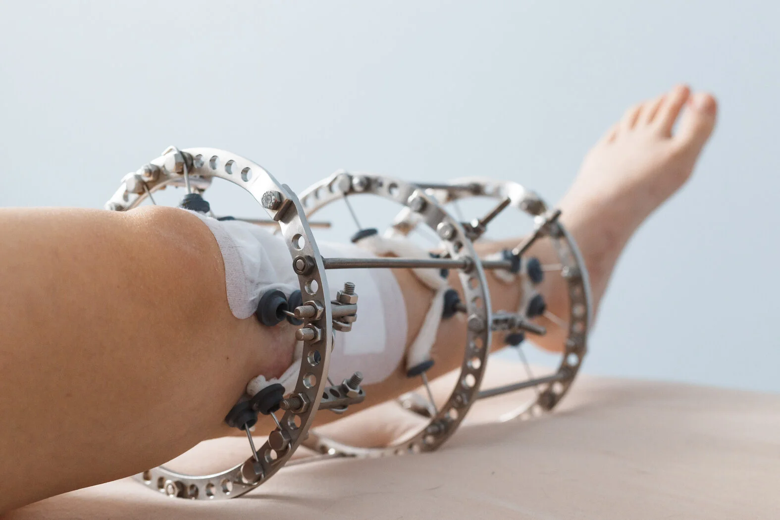 Fixateur externe: Empfehlungen zu Pflege und Infektionsprophylaxe