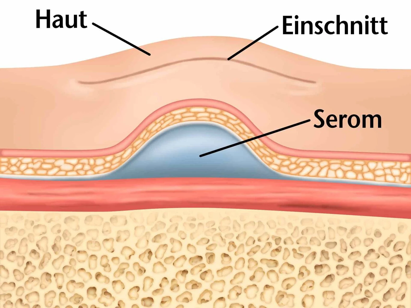 Serom: Serome und Pseudozysten in der Wundheilung
