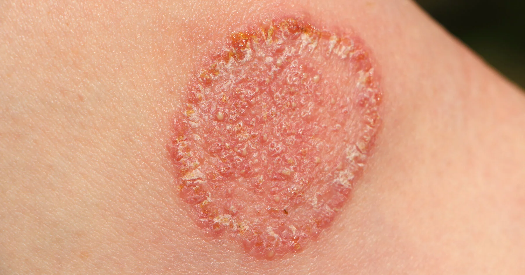 Dermatomykosen - erkennen, behandeln und vorbeugen