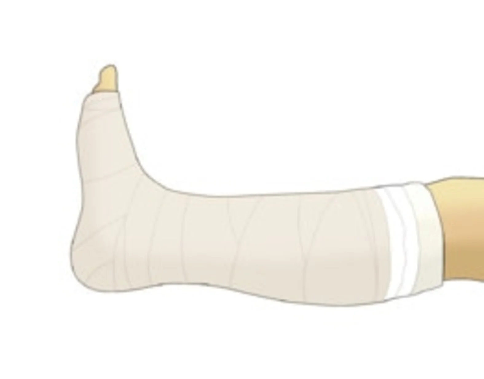 Ulcus cruris venosum - Wundversorgung