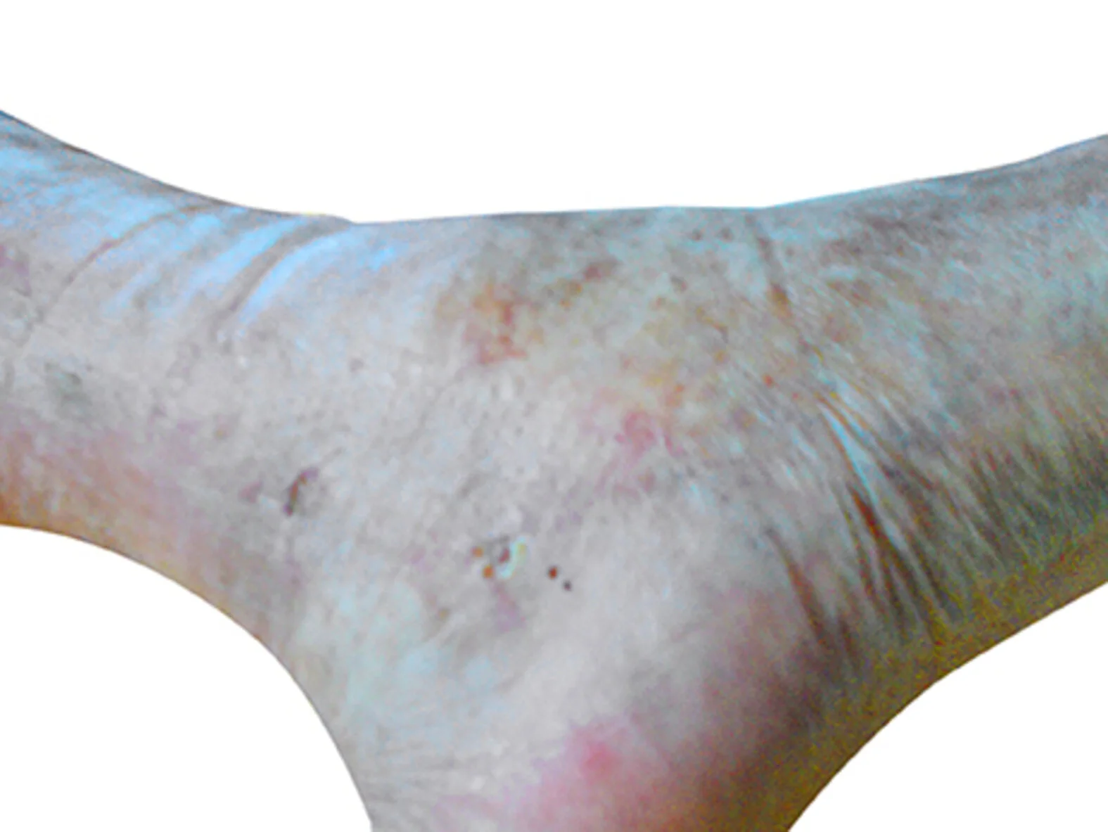 Ulcus cruris venosum - Wundversorgung