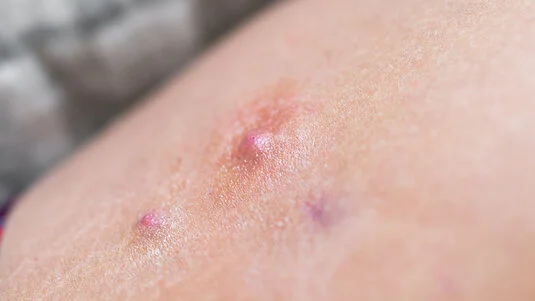 Acne inversa, Hidradenitis suppurativa: Wundversorgung, Behandlung