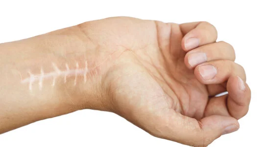 Narben – Physiologie, Narbenprophylaxe und Narbenpflege