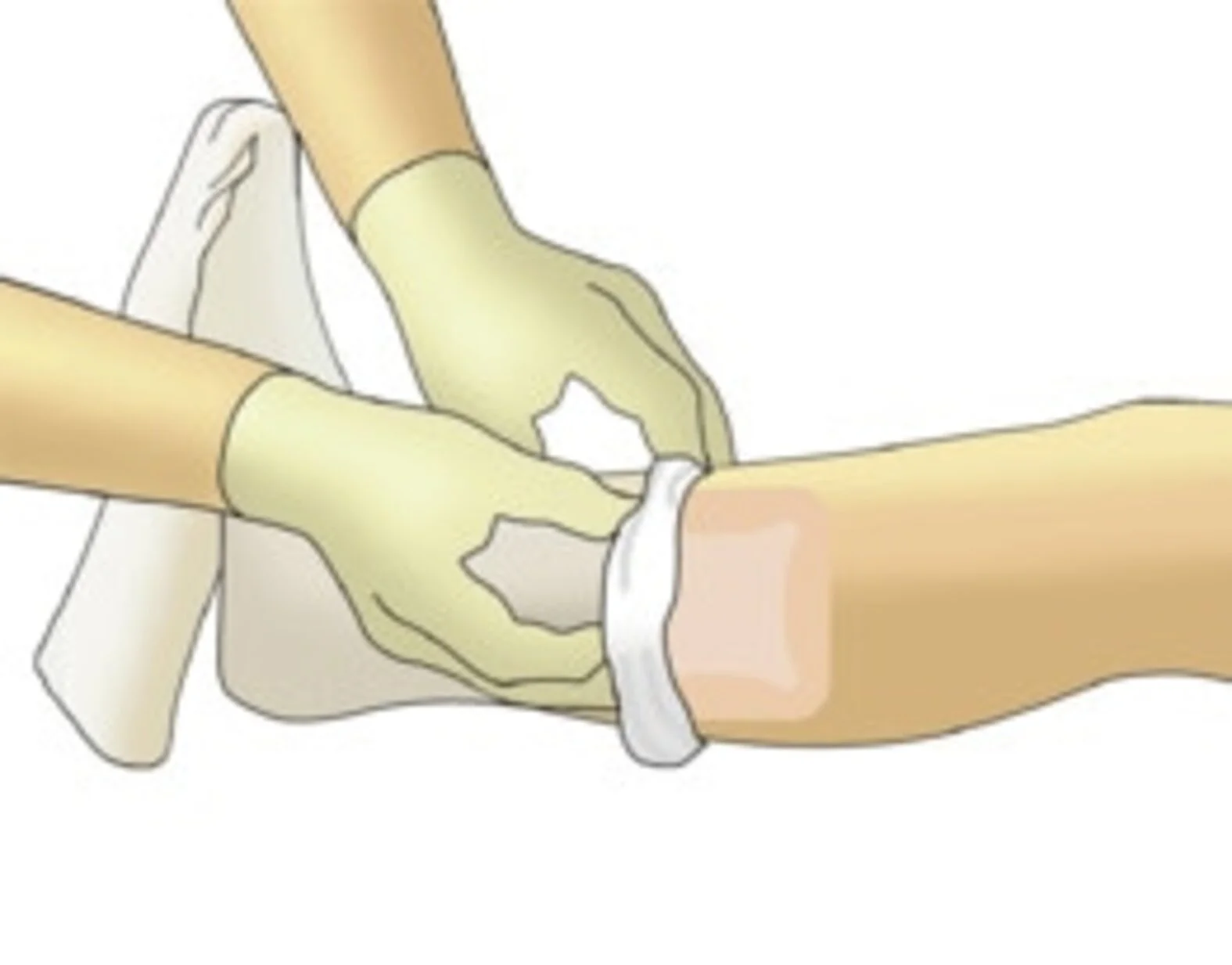 Ulcus cruris venosum - Wundversorgung