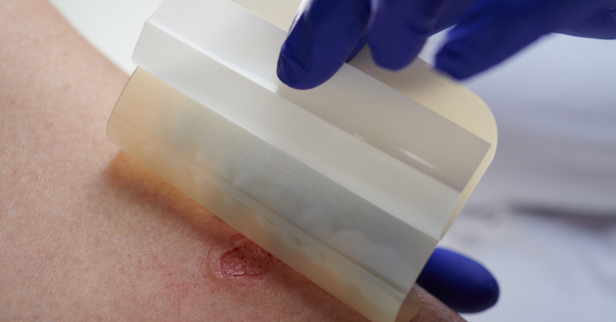 Hydrokolloide Wundauflagen, Hydrokolloid-Pflaster - DRACO - DRACO