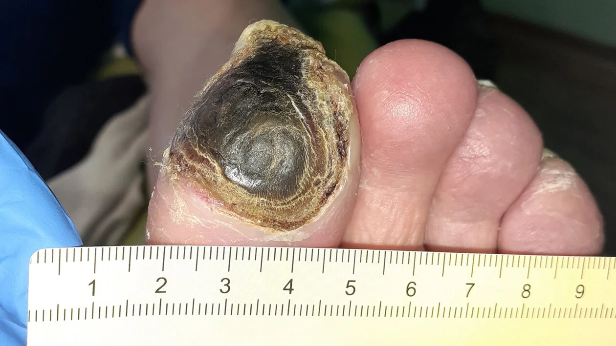 Fallbeispiel: Nekrose bei Neuropathie & pAVK, Heilung, Bilder