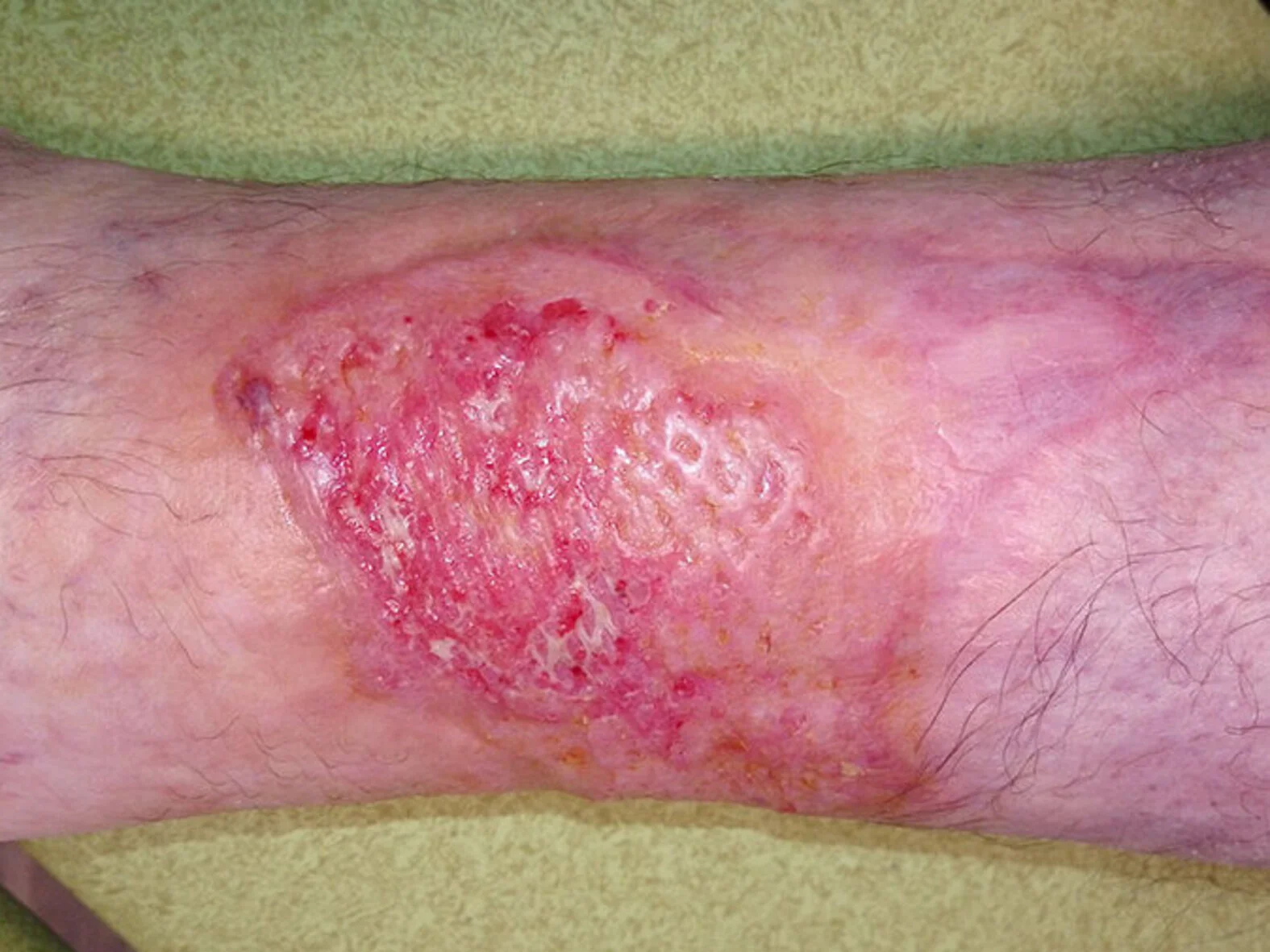 Fallbeispiel: Pyoderma gangraenosum, Wundversorgung