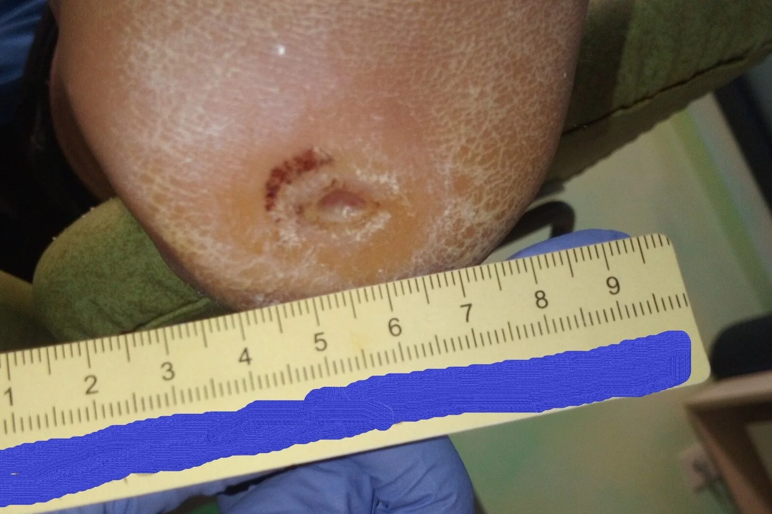 Fallbeispiel: Fersenulcus bei Diabetischem Fußsyndrom (DFS) mit Bildern