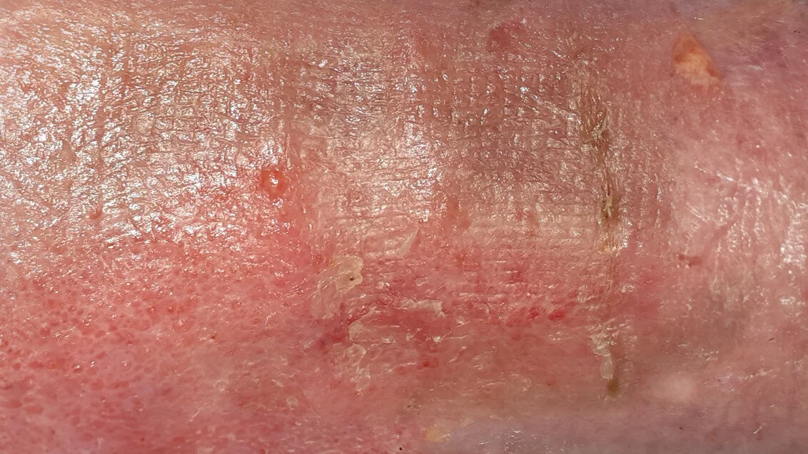 Fallbeispiel: Ulcus cruris venosum an beiden Unterschenkeln