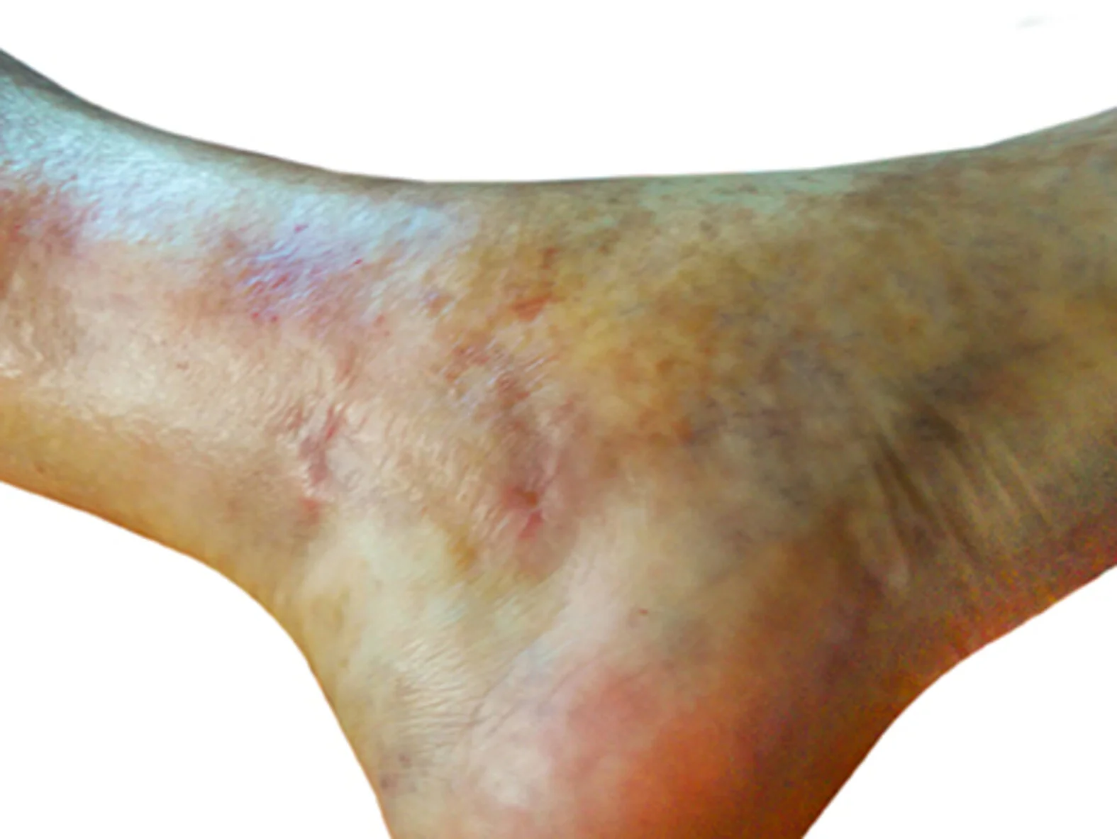 Ulcus cruris venosum - Wundversorgung