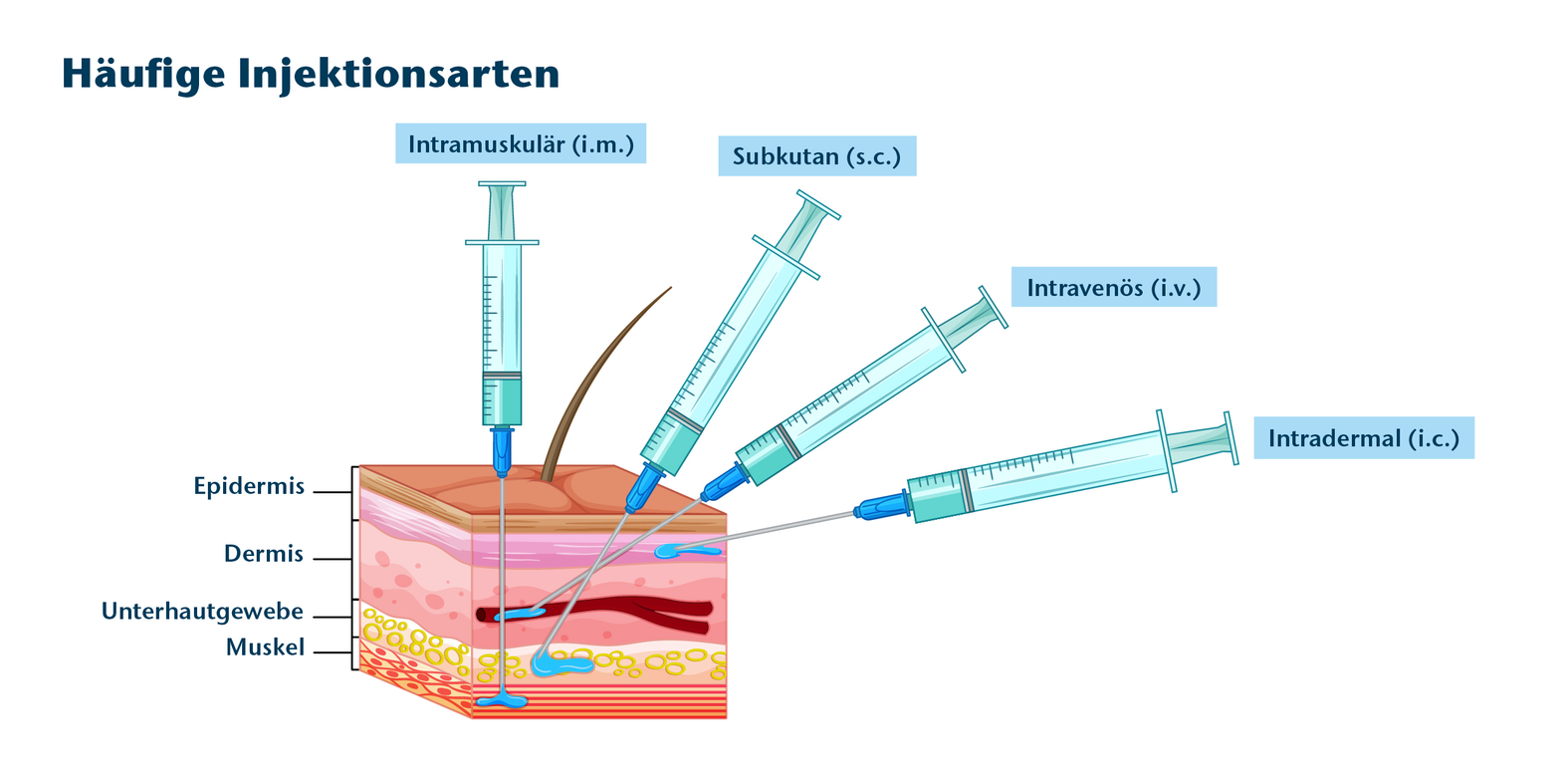 Injektionen verabreichen: Injektionsarten und Vorbereitung
