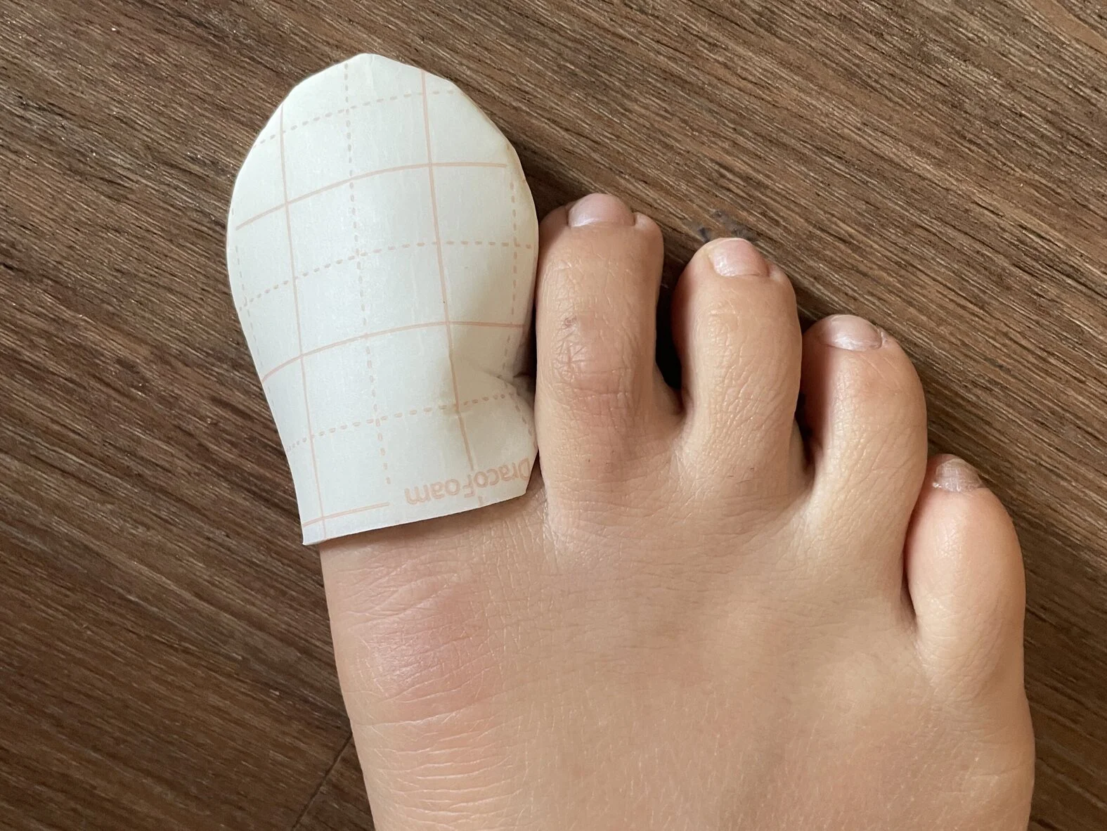 Fallbeispiel: Nagelbettentzündung nach Verletzung bei Pediküre