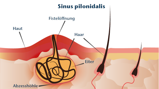 Sinus pilonidalis, Pilonidalsinus: Symptome, Therapie