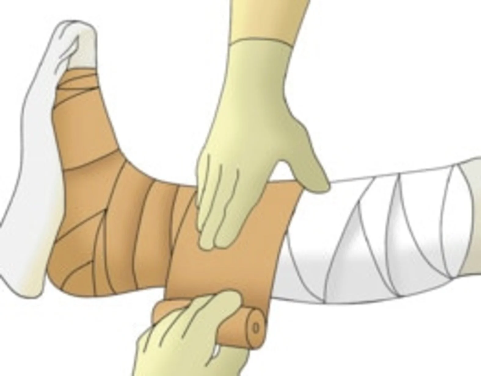 Ulcus cruris venosum - Wundversorgung