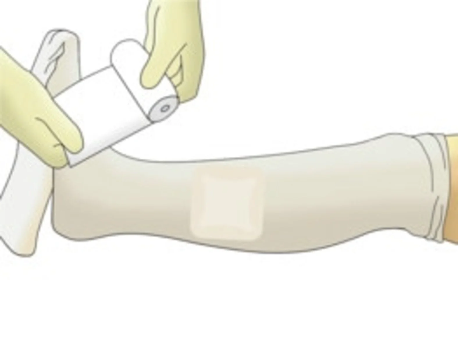 Ulcus cruris venosum - Wundversorgung