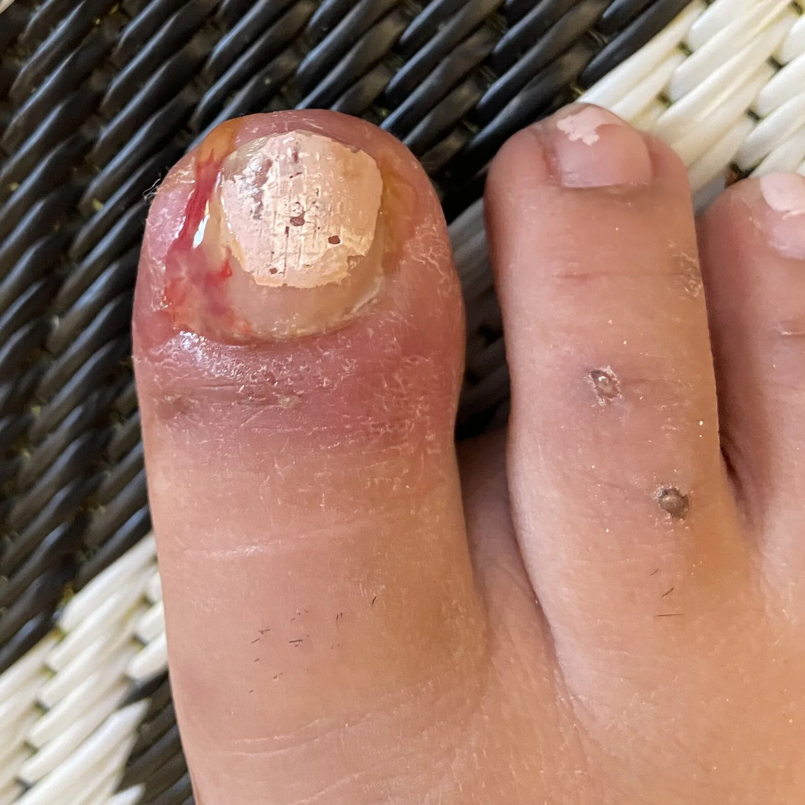 Nagelbettentzündung richtig behandeln und vorbeugen