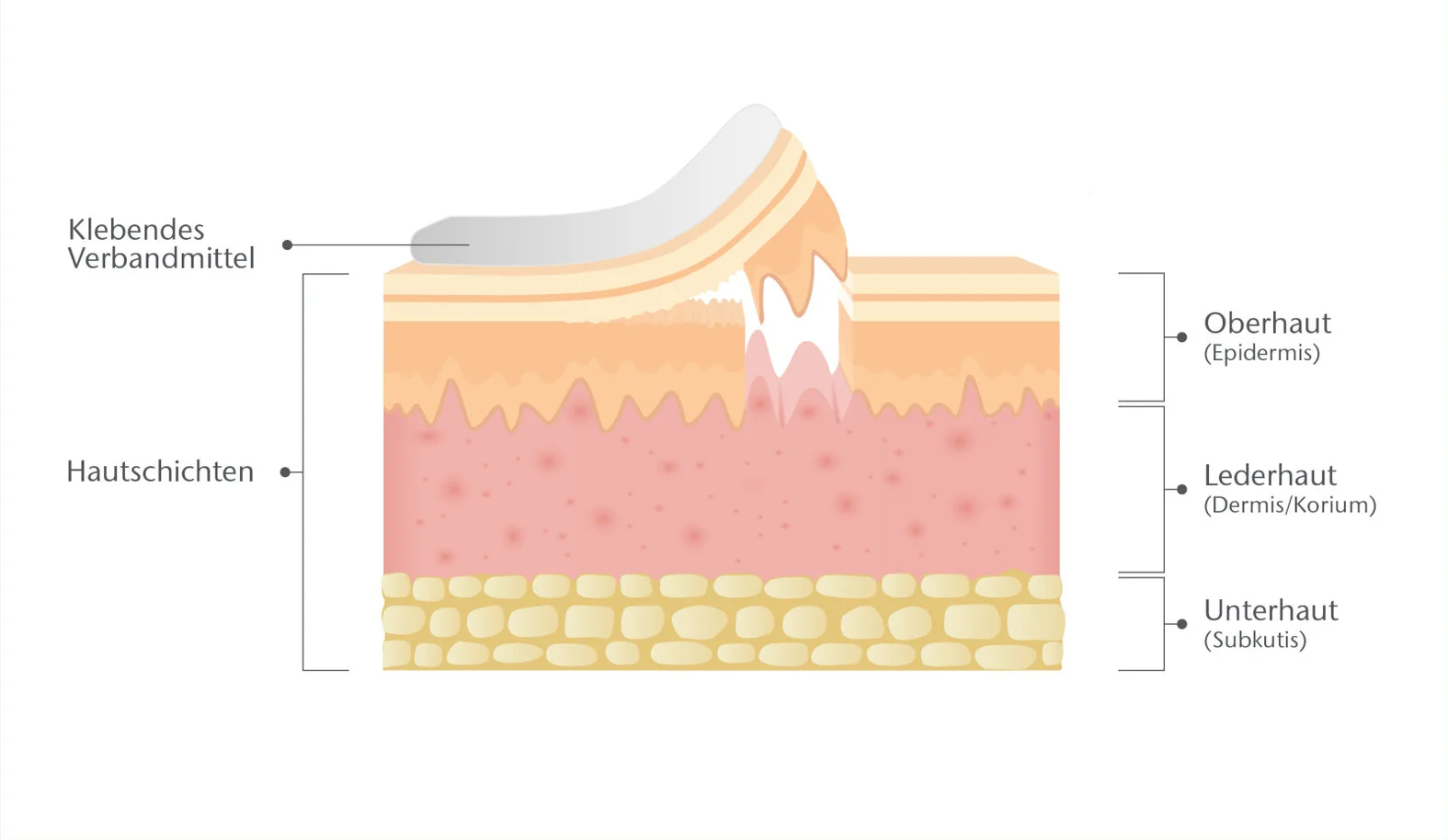 Medical Adhesive-Related Skin Injuries (MARSI): unterschätzt, vermeidbar