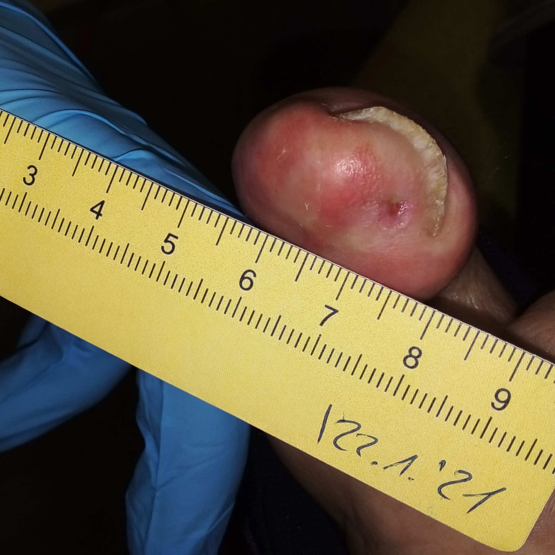 Fallbeispiel: Wundheilung feuchte und trockene Nekrose nach Sepsis